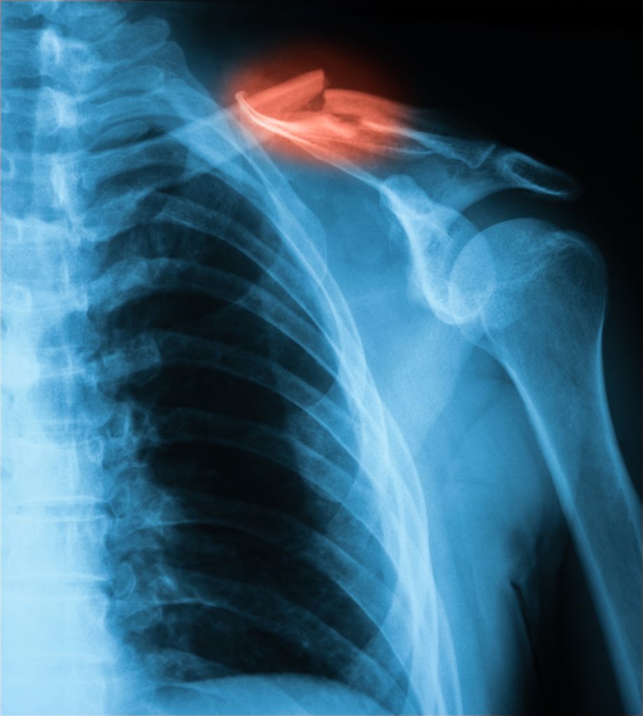Collar bone fracture - Valkhades