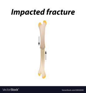 Impacted Fracture - Valkhades