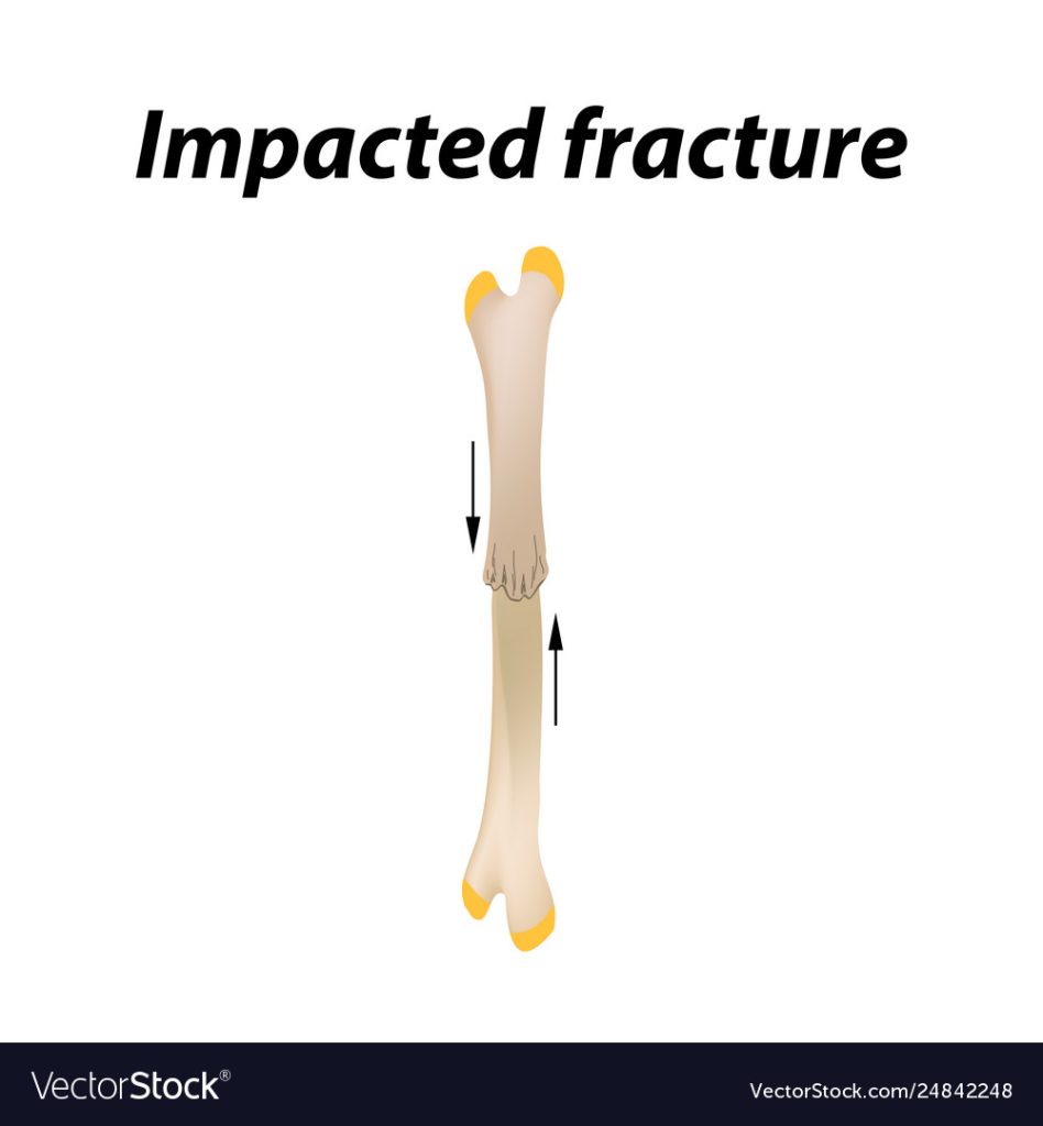Impacted Fracture - Valkhades